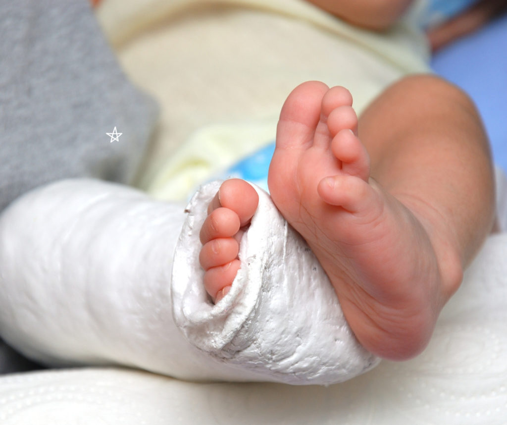 Stopa przywiedziona (sierpowata) u dziecka – sytuacja kiedy stopa ...