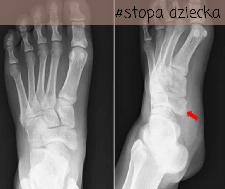 Dodatkowa kość łódkowata - czy operować? - Fizjostópki